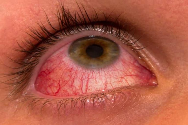 Vernal Keratokonjonktivit Nedir? Bilinmesi Gereken Her Şey